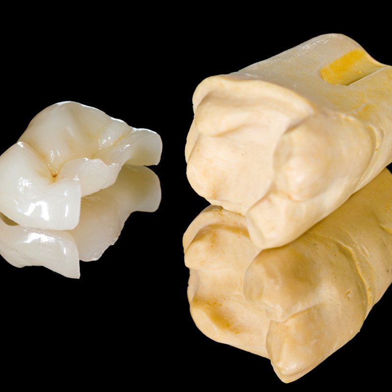 Dental Inlays & Onlays St. Louis, MO - Perfect Smiles STL